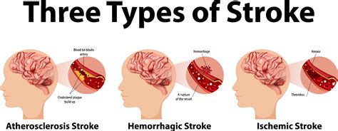 Infographic Of Common Types Of Stroke 8386943 Vector Art At Vecteezy