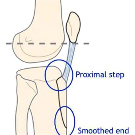 Tibial Tubercle Osteotomy With Proximal Buttress Spur And Smoothed End
