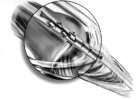 Figure 1 From Surgical Correction Of Extensor Tendon Subluxation And Ulnar Drift In The