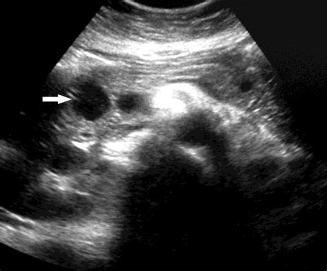 52 Year Old Woman Presenting With Recurrent Retroperitoneal Download Scientific Diagram