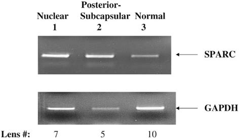 Figure 4 From Increased Expression Of Osteonectinsparc Mrna And