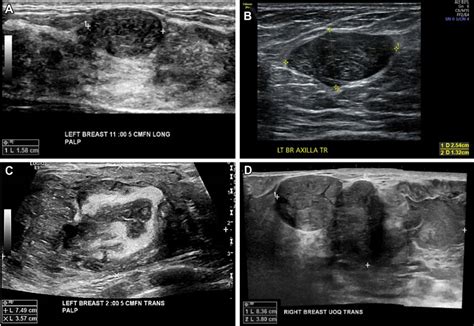Phyllodes Tumors May Display A Range Of Ultrasound Appearances And