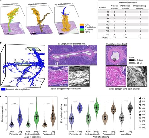 3d Patterns In Pancreatic Cancer Invasion A Occurrence Of Venous Download Scientific Diagram