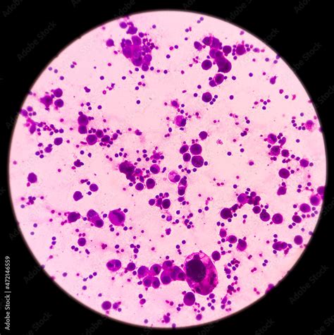 Malignant Cellscancer Cells Pleural Fluid Cytology Of Lung