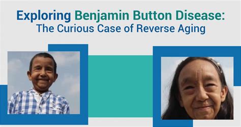 Exploring Benjamin Button Disease The Curious Case Of Reverse Aging