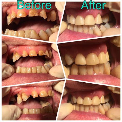 Acorn Dental Dentist In York Composite Build Ups