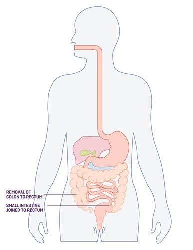 Surgery For Ulcerative Colitis
