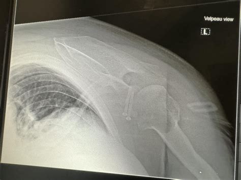Velpeau View Rradiology