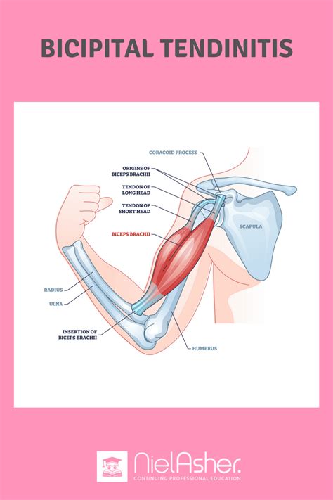 Bicipital Tendinitis Results From Irritation And Inflammation To The Biceps Brachii Tendon Read