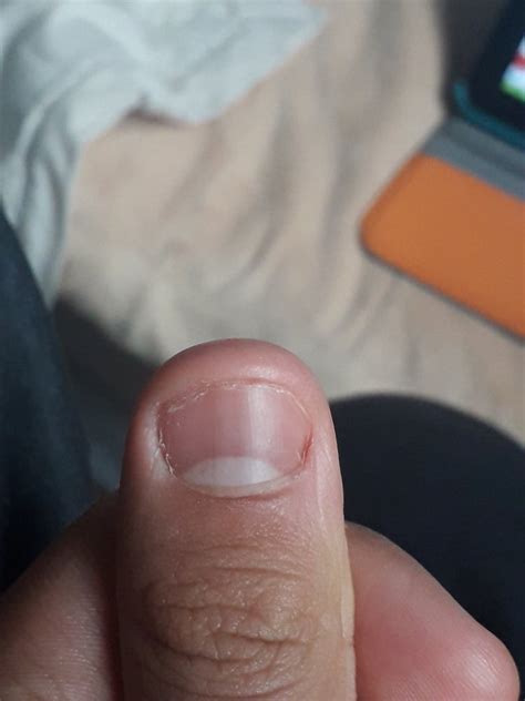 엄지손톱 검은 세로줄 지식in