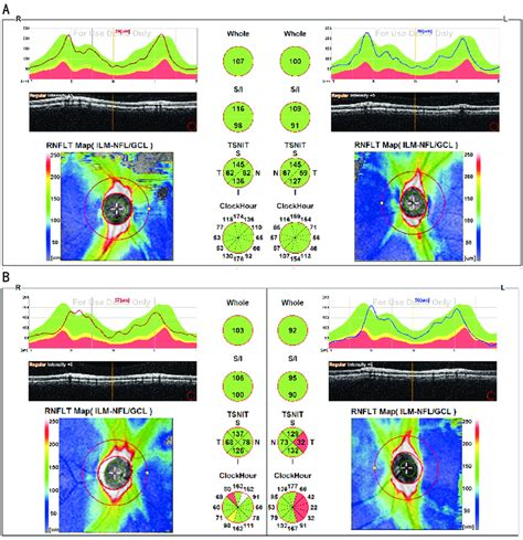 Oct Photographs Of Rnfl Thickness From A Typical Patient Red Indicates Download Scientific