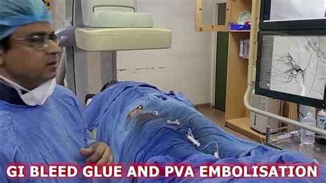 Gi Bleed Glue And Pva Embolisation Youtube