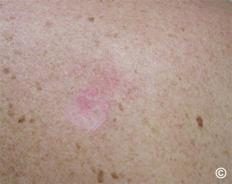 Superficial Basal Cell Carcinoma