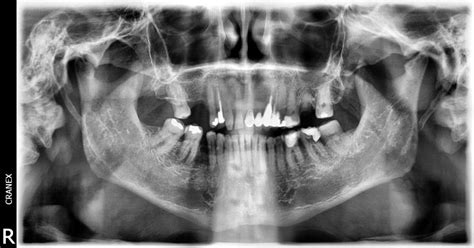 Zaynifer Manrique On Linkedin Osteoarthritis Of The Tmj The Tmj Is A Synovial Joint Comprising