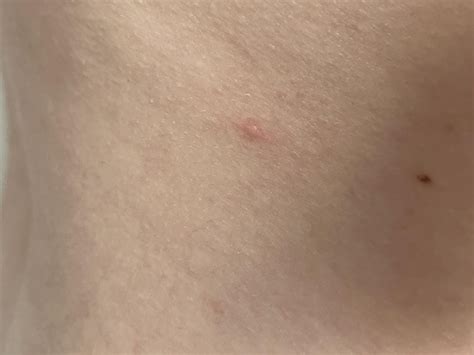 What Kind Of Bite Is This Are These Bed Bugs Flea Bites Pls Help R Bugbite