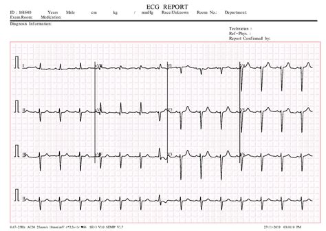 Ecg Dataset Roboflow Universe