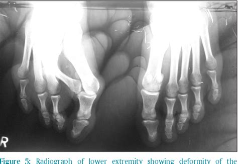 Figure 1 From Ectrodactyly Ectodermal Dysplasia Cleft Lip Palate Syndrome A Rare Entity