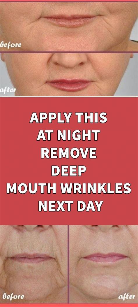 Apply This At Night Remove Deep Mouth Wrinkles Next Day Healthy Lifestyle