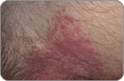 Rash In Mens Groin Area