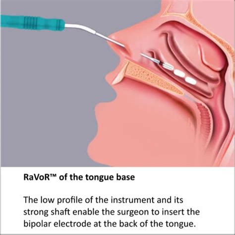 Rf Signal Generator At ₹ 850000 Set Rf Cautery In Chemancheri Id 2854300478891