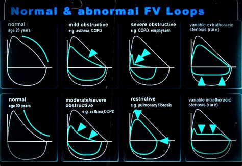 Normal And Abnormal Flow Volume Loops Medical Sciences Facebook