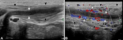 Pathologic Conditions At Imaging Of The Spermatic Cordradiographics