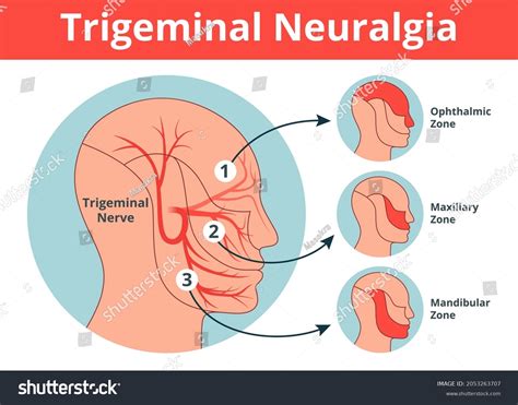 Trigeminal Nerve Anatomy Trigeminal Neuralgia Pain Stock Vector Royalty Free 2053263707