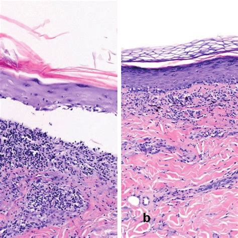 Erythematous And Hyperpigmented Scaly Plaques Either Sharply Or