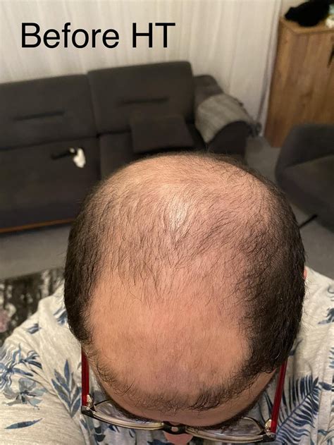 6 Months Post Ht R Hairtransplants