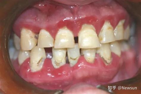 天天刷牙为什么还会得牙周炎？（附图片） 知乎