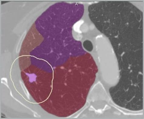 Distance Between Tumor And Segment Border 2 Mm Download Scientific