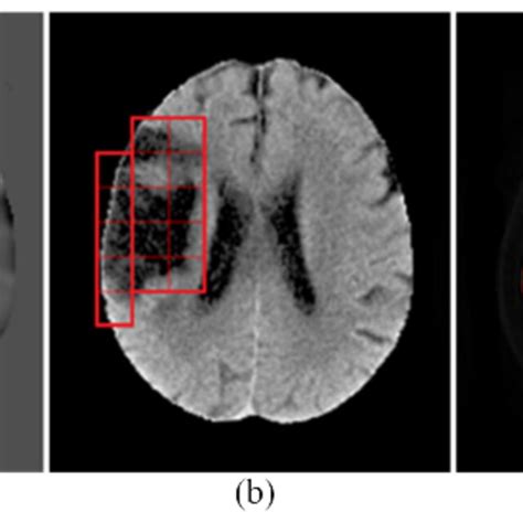 An Exemplary Result Of Infarct Detection By The Proposed Cnn A The Download Scientific