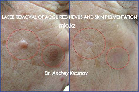 ᐈЛазерное удаление пигментных пятен в Алматы цена отзывы Удаление пигментации лазером от Mlc