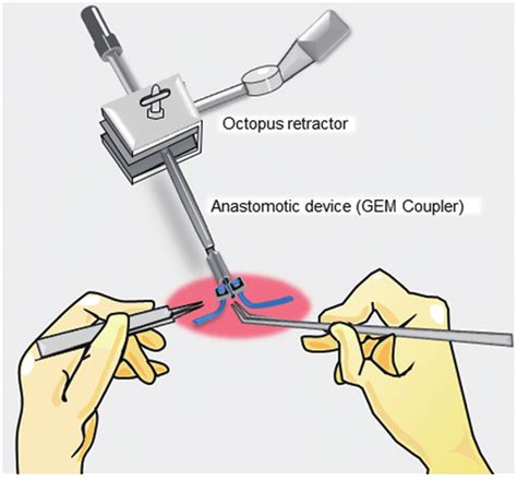 Schematic Illustration Of The Microsurgical Procedures Certain Tip