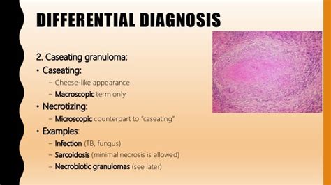 Flashpath Lung Pulmonary Hyalinizing Granuloma