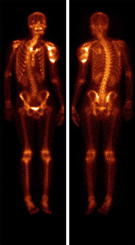 Whole Body 99m Tc Methylene Diphosphonate Bone Scan Imaging Abnormal
