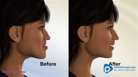 Mandibular Setback Link10 Ir