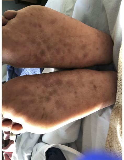 Rapid Plasma Reagin In The Danger Zone A Case Of The Prozone Effect In Secondary Syphilis Shm