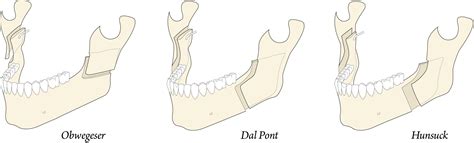 Bad Splits In Bilateral Sagittal Split Osteotomy Systematic Review Of