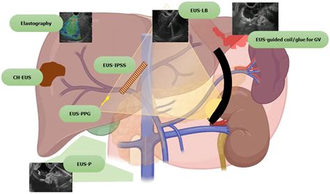 Spectrum Of Endoscopic Ultrasound In Hepatology Eus Endoscopic