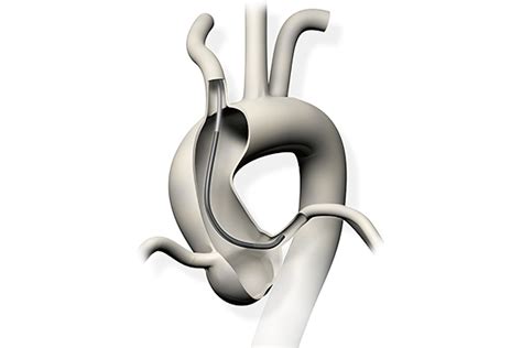 Profit™ 6f Plus Guiding Catheter Interventional Products Medical Device Business Our