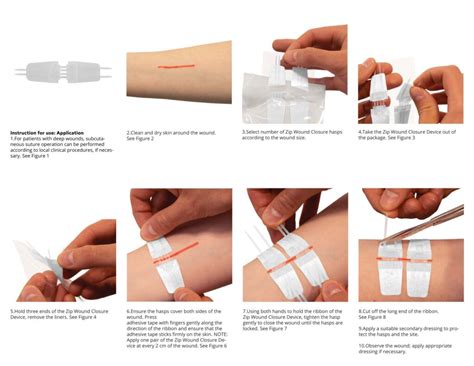 Zipstitch Wound Closure Device Longmed Zip Strip Sutures
