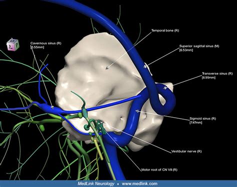 Temporal Bone Cranial Nerves And Dural Sinuses Labeled Medlink Neurology