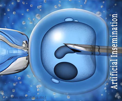 What Are The 4 Types Of Artificial Insemination At Angel Singleton Blog