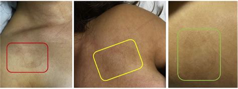 Hyperpigmentation Induced By Ecg Electrodes Unexpected Finding One