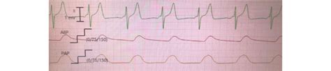 Pressure Waveforms At The Left Radial Artery And The Tip Of The