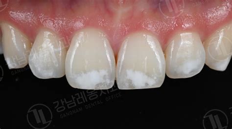 백색반점 제거 강남레옹치과