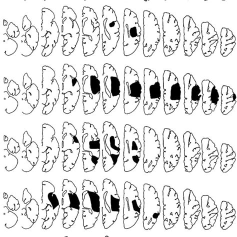 Lesioned Areas In The Patients With Pure Left Sided Neglect Neg The