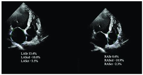 left on the left side and right on the right side atrial speckle