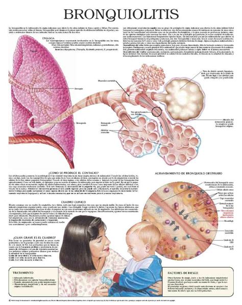 Bronchiolitis Anejo